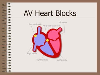 Heart blocks | PPTX