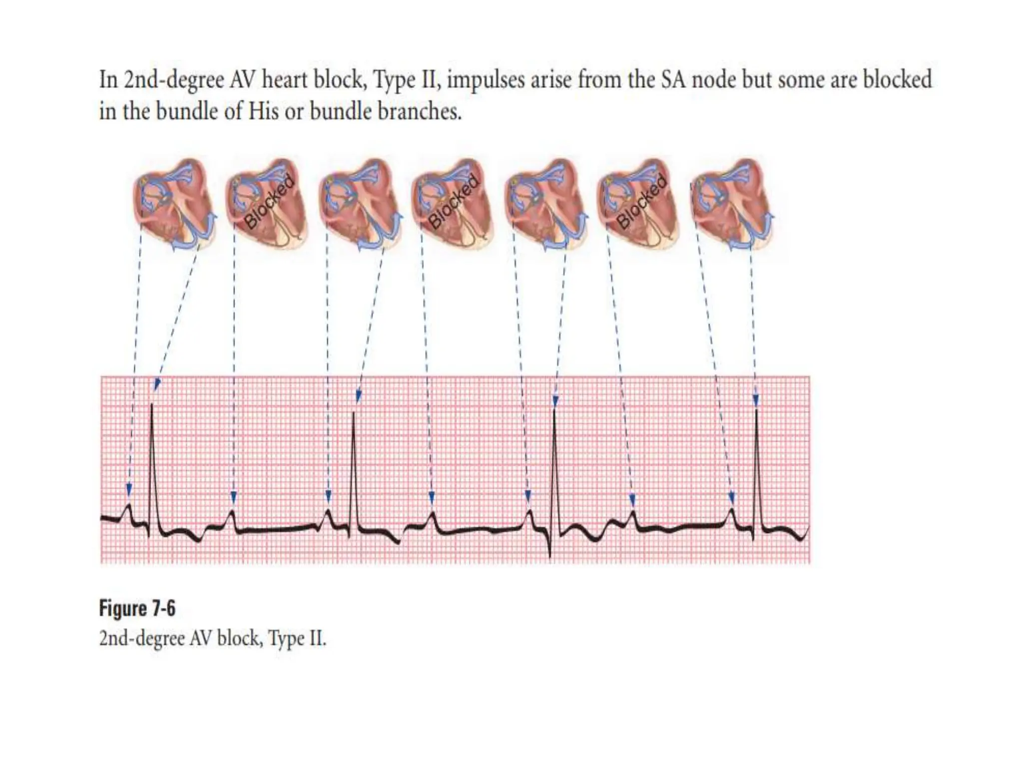 HEART BLOCKS IN ECG AND HOW TO INTEPRET IN ECG? | PPT
