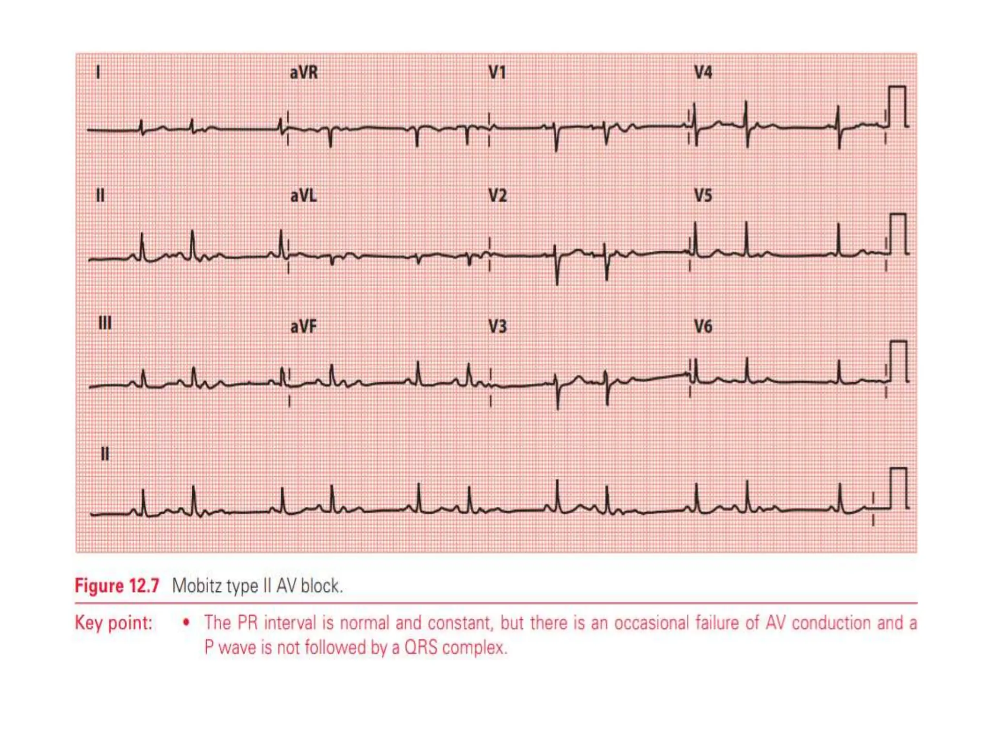 HEART BLOCKS IN ECG AND HOW TO INTEPRET IN ECG? | PPT