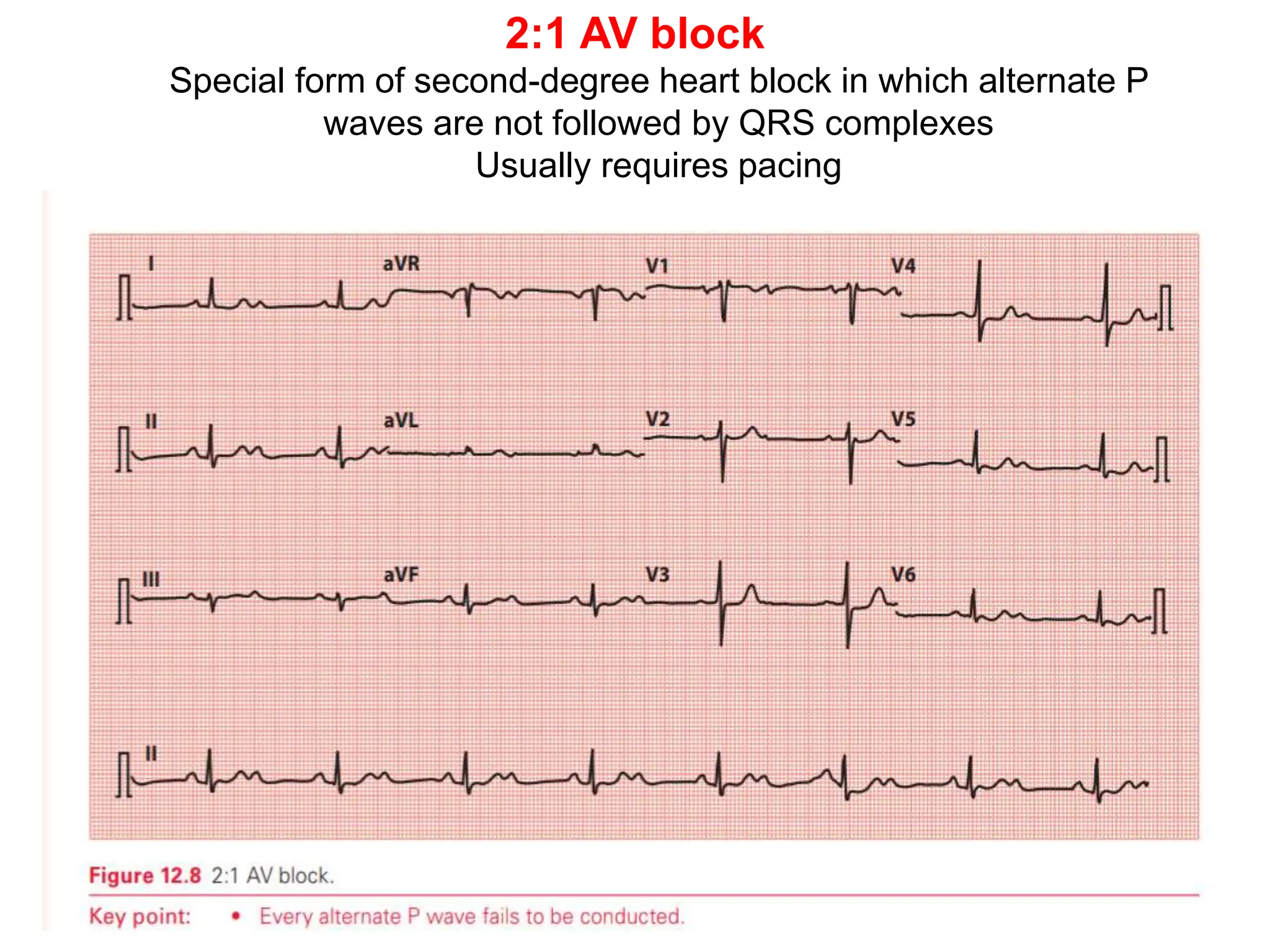 HEART BLOCKS IN ECG AND HOW TO INTEPRET IN ECG? | PPT