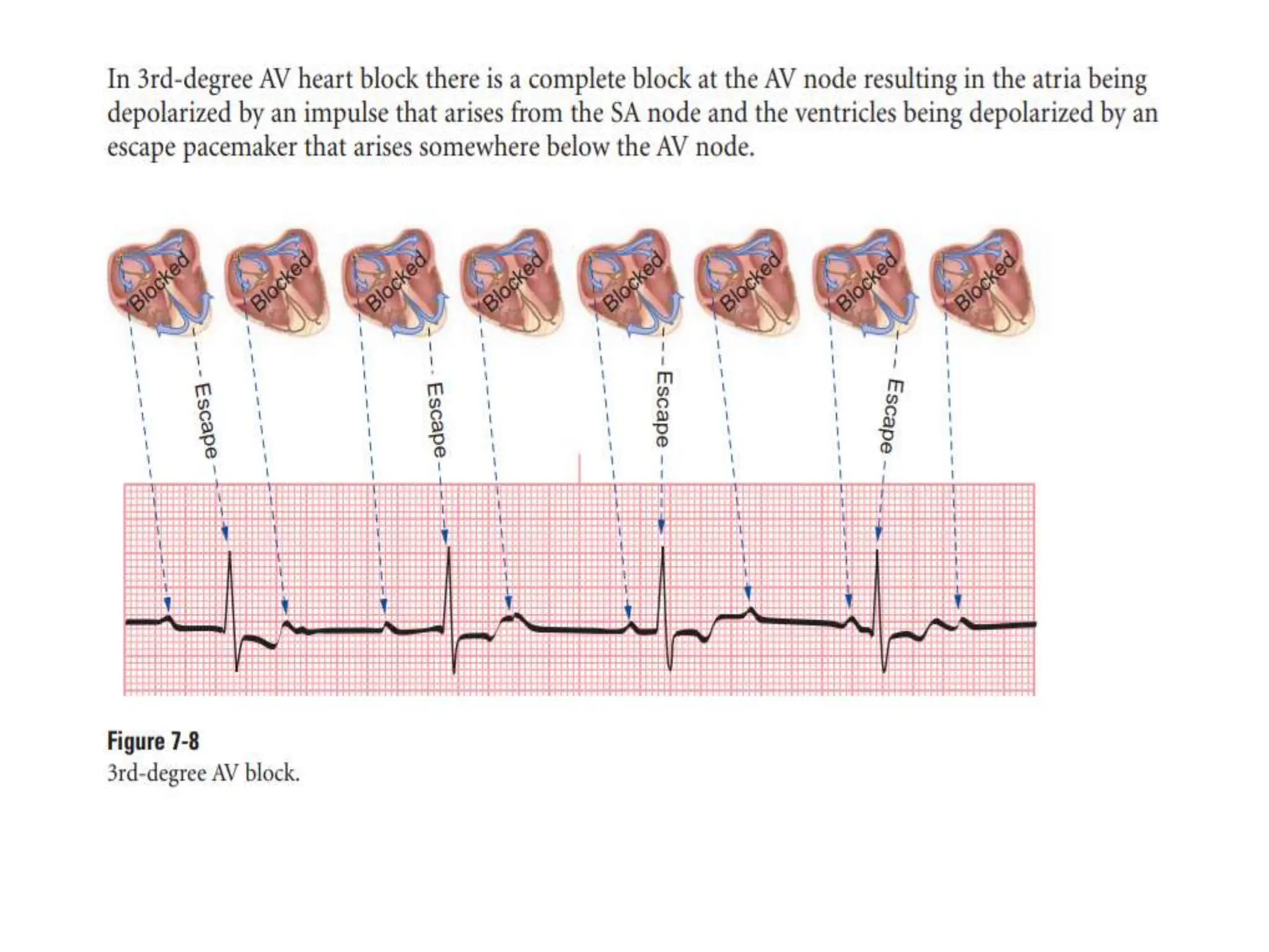 HEART BLOCKS IN ECG AND HOW TO INTEPRET IN ECG? | PPT