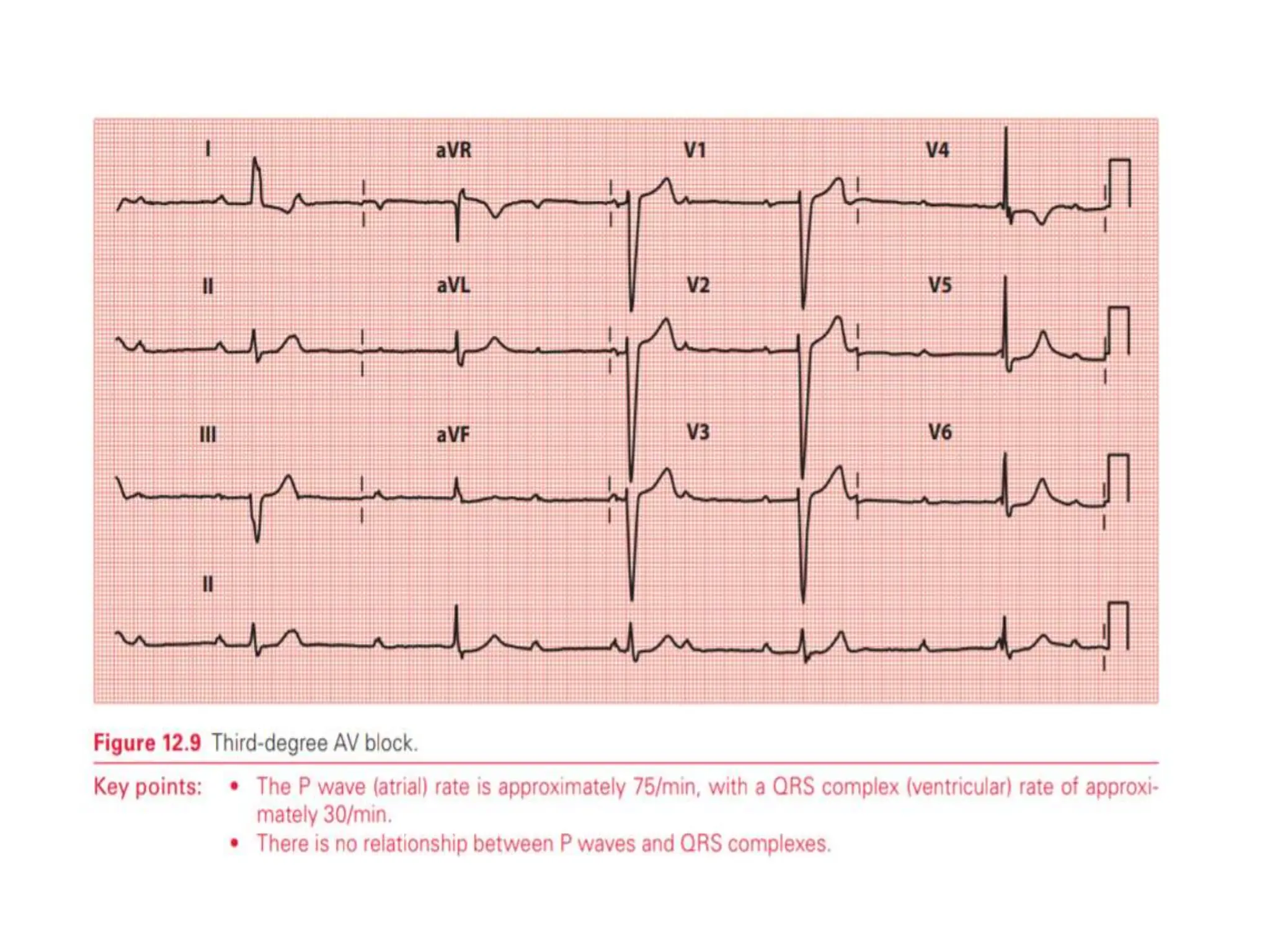 HEART BLOCKS IN ECG AND HOW TO INTEPRET IN ECG? | PPT