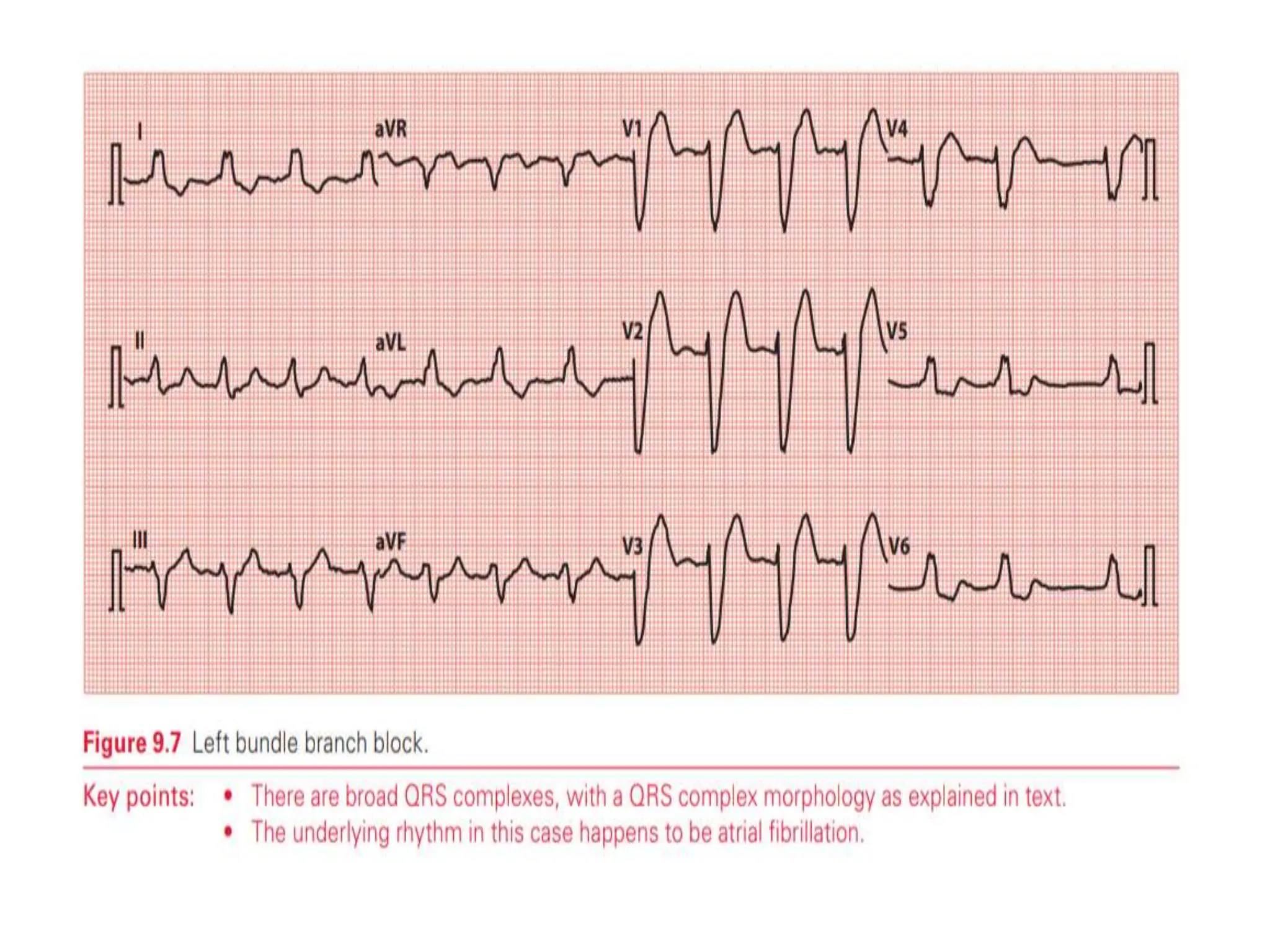 HEART BLOCKS IN ECG AND HOW TO INTEPRET IN ECG? | PPTX