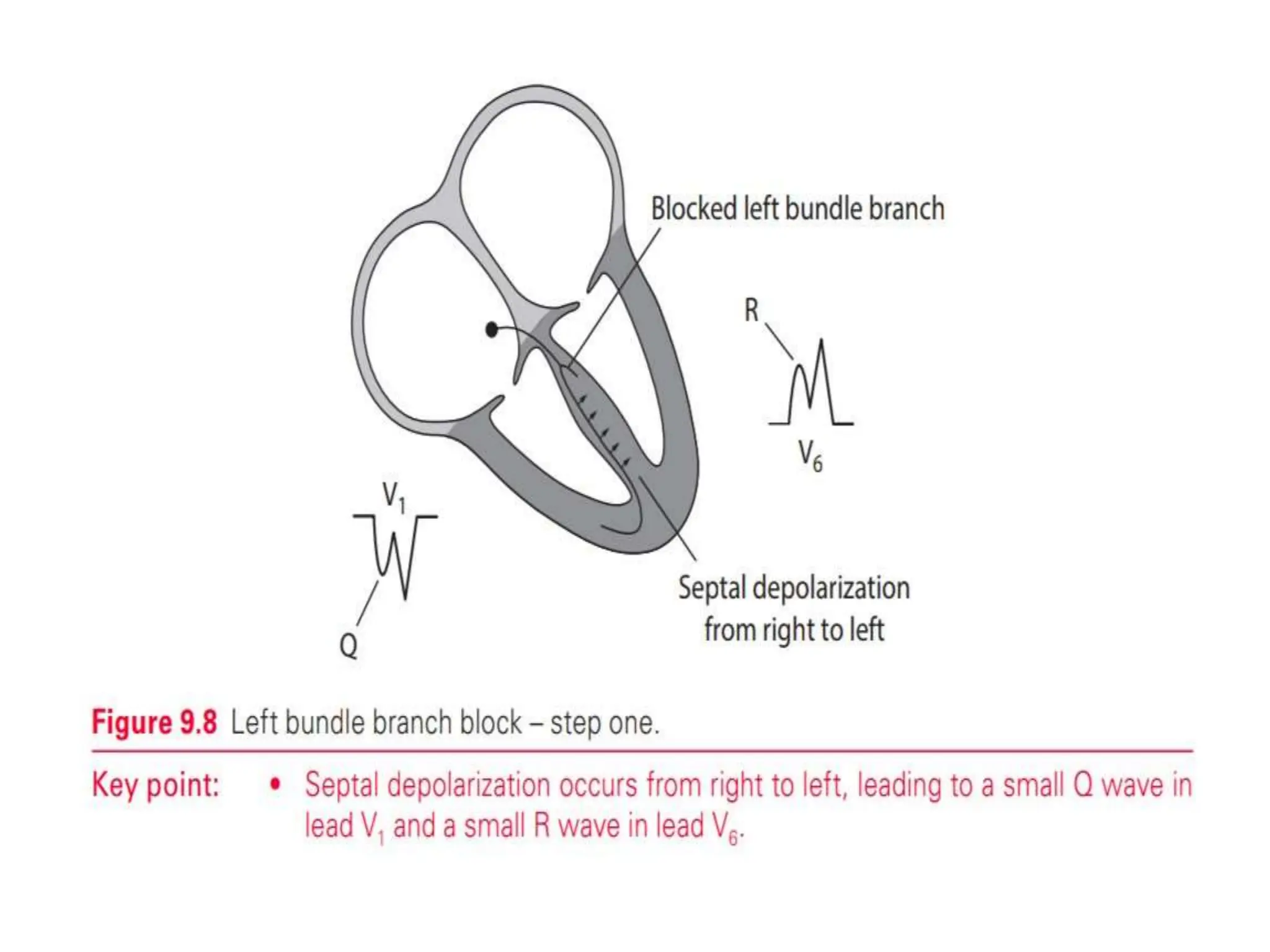 HEART BLOCKS IN ECG AND HOW TO INTEPRET IN ECG? | PPTX