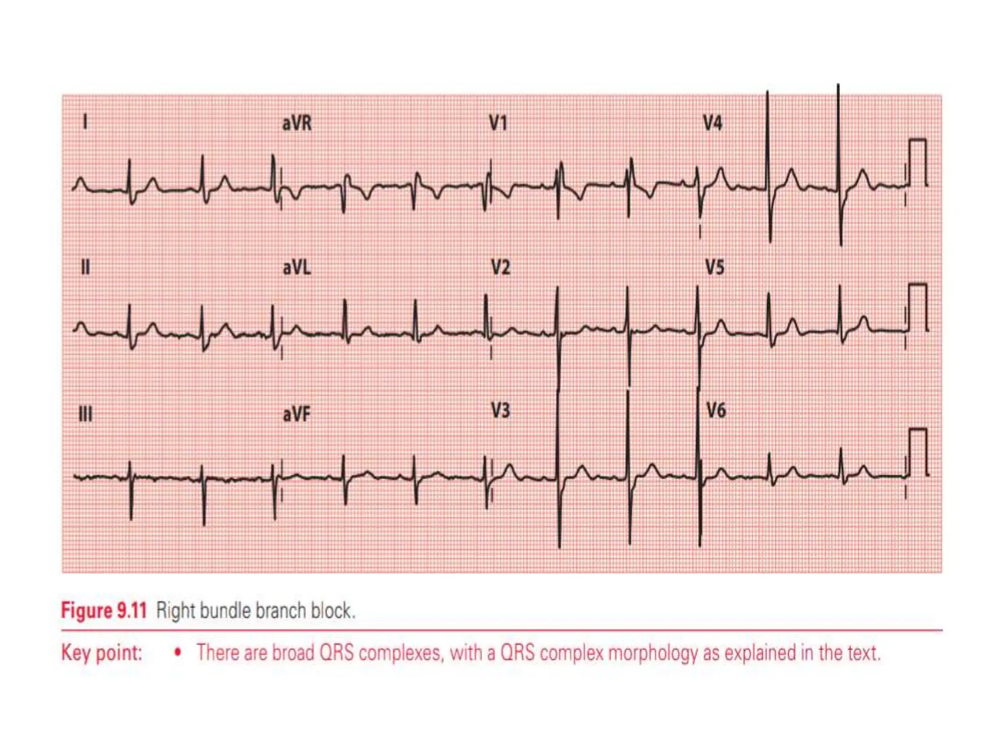 HEART BLOCKS IN ECG AND HOW TO INTEPRET IN ECG? | PPT