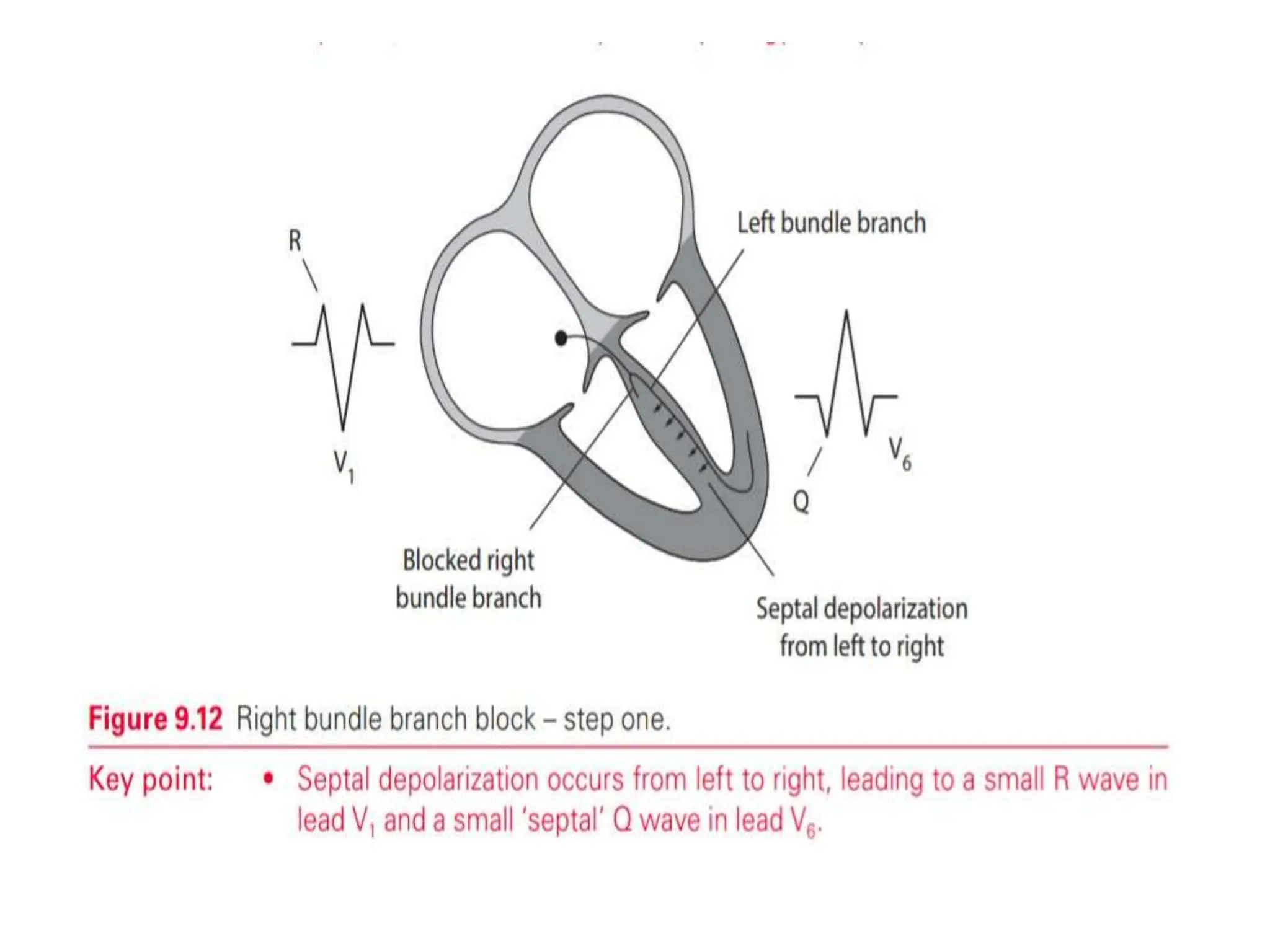 HEART BLOCKS IN ECG AND HOW TO INTEPRET IN ECG? | PPTX