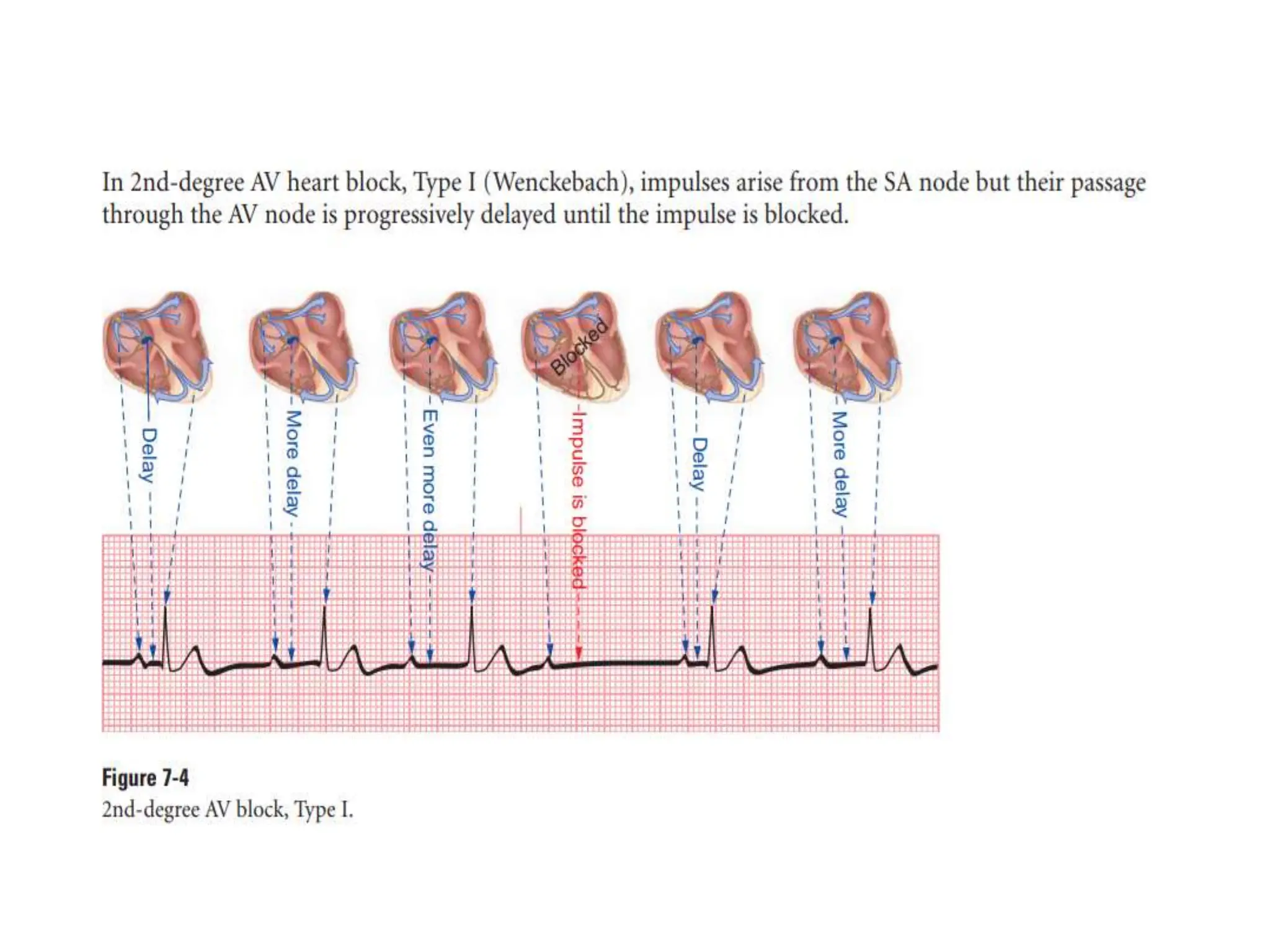 HEART BLOCKS IN ECG AND HOW TO INTEPRET IN ECG? | PPT