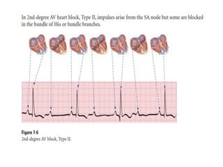 HEART BLOCKS IN ECG AND HOW TO INTEPRET IN ECG? | PPT
