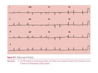 HEART BLOCKS IN ECG AND HOW TO INTEPRET IN ECG? | PPT