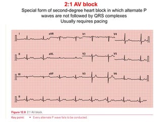 HEART BLOCKS IN ECG AND HOW TO INTEPRET IN ECG? | PPT