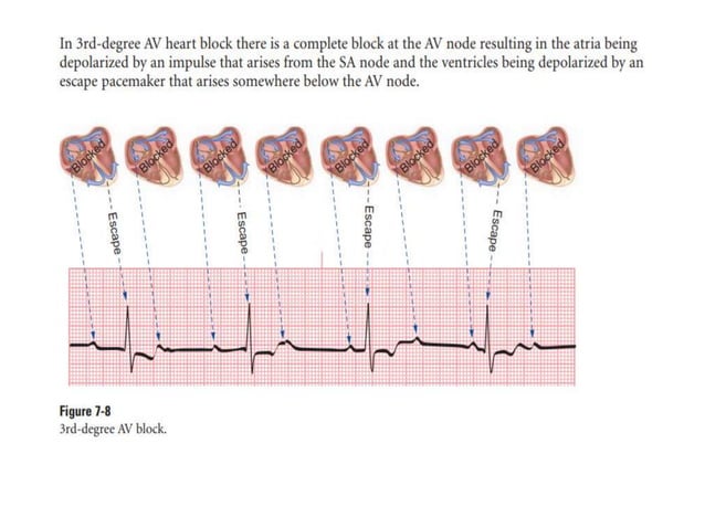 HEART BLOCKS IN ECG AND HOW TO INTEPRET IN ECG? | PPT