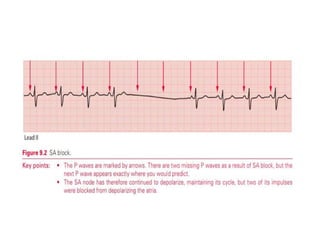 HEART BLOCKS IN ECG AND HOW TO INTEPRET IN ECG? | PPT