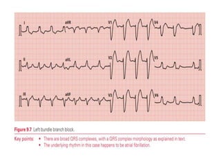 HEART BLOCKS IN ECG AND HOW TO INTEPRET IN ECG? | PPT