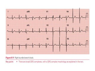 HEART BLOCKS IN ECG AND HOW TO INTEPRET IN ECG? | PPTX
