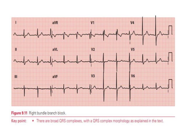 HEART BLOCKS IN ECG AND HOW TO INTEPRET IN ECG? | PPT
