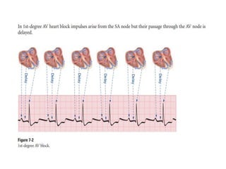 HEART BLOCKS IN ECG AND HOW TO INTEPRET IN ECG? | PPT