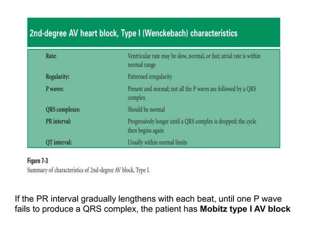 HEART BLOCKS IN ECG AND HOW TO INTEPRET IN ECG? | PPT