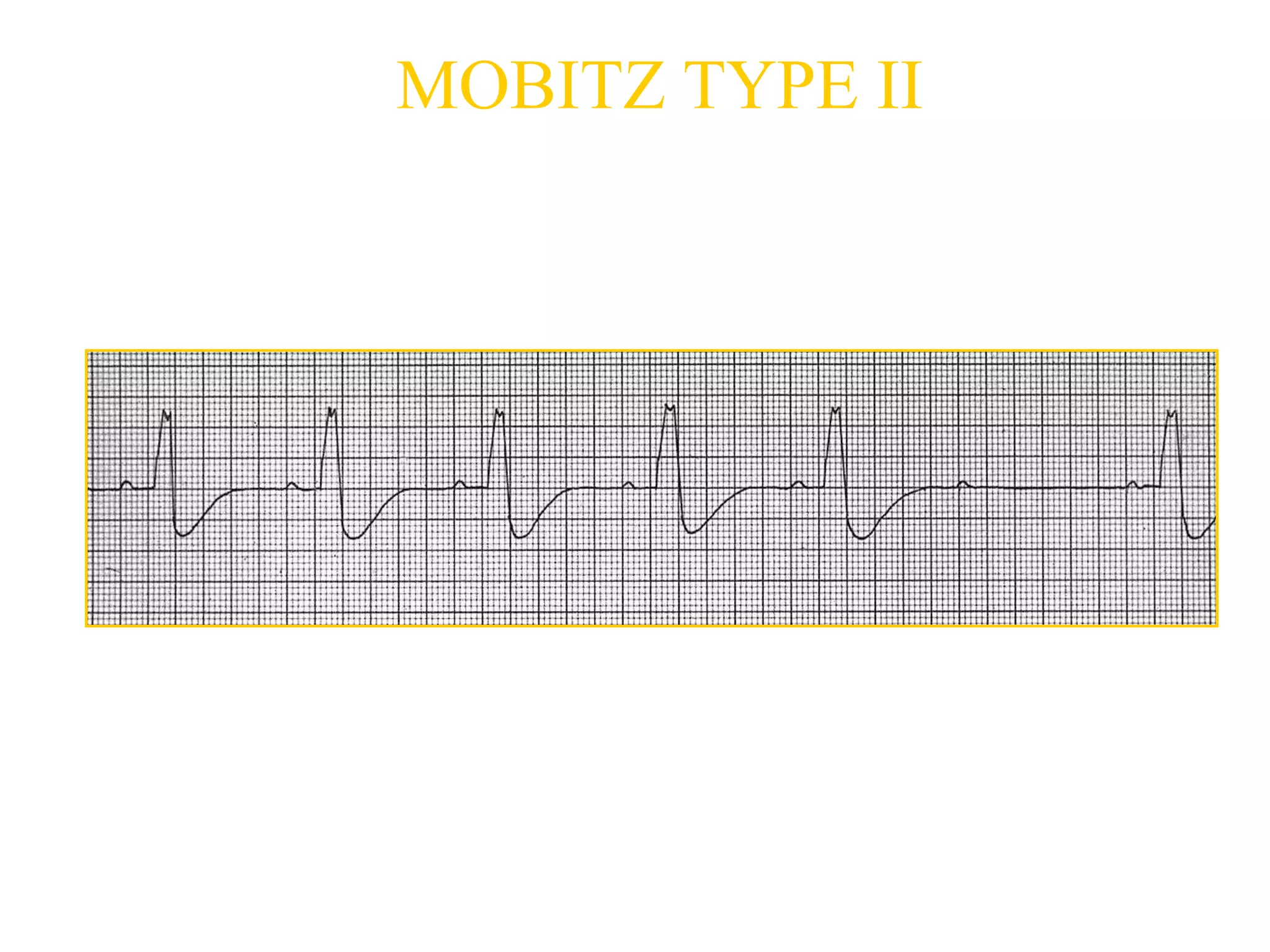 Heart blocks and pacemakers 2019 | PPTX