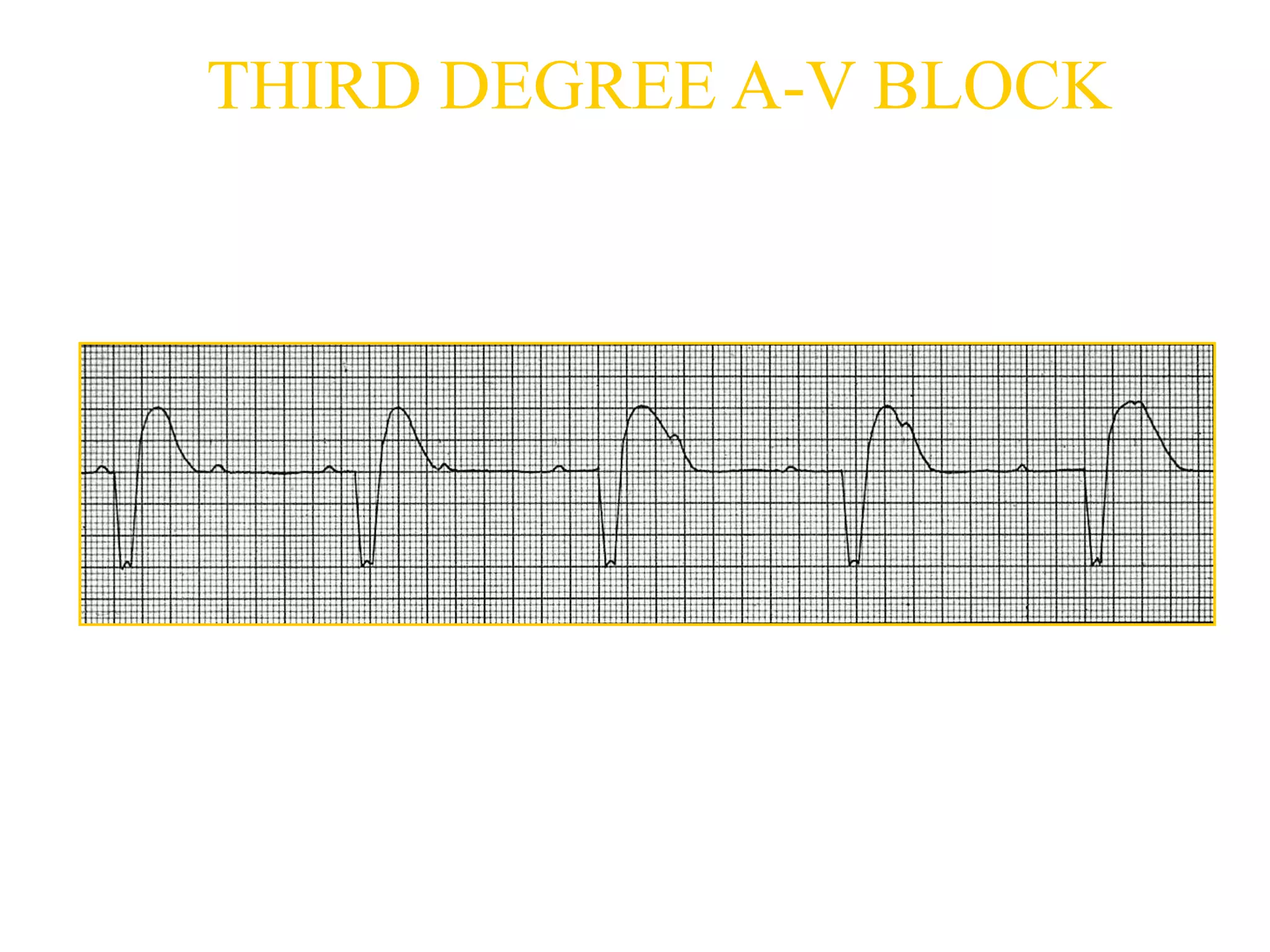 Heart blocks and pacemakers 2019 | PPTX