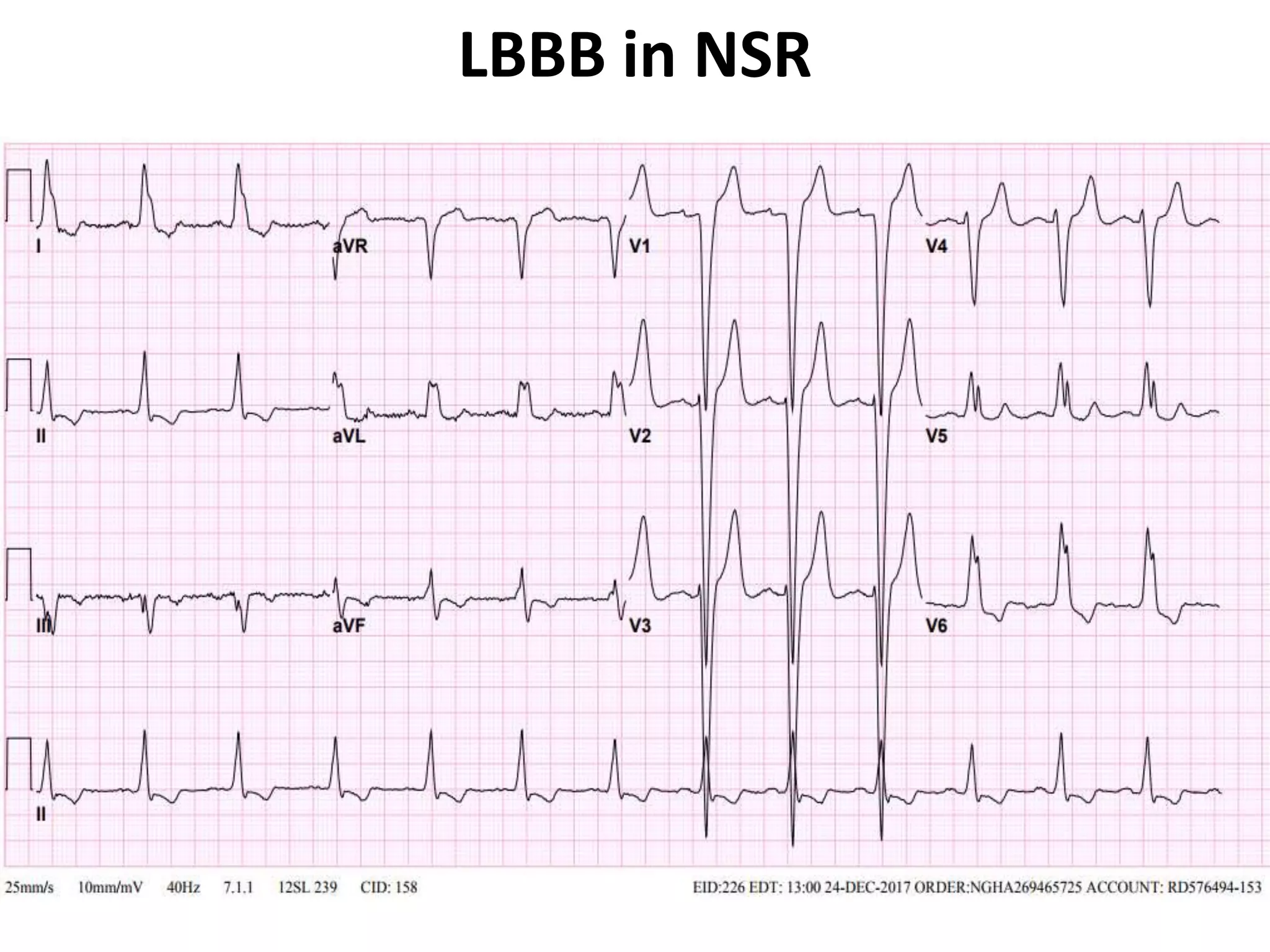 Heart blocks and pacemakers 2019 | PPTX