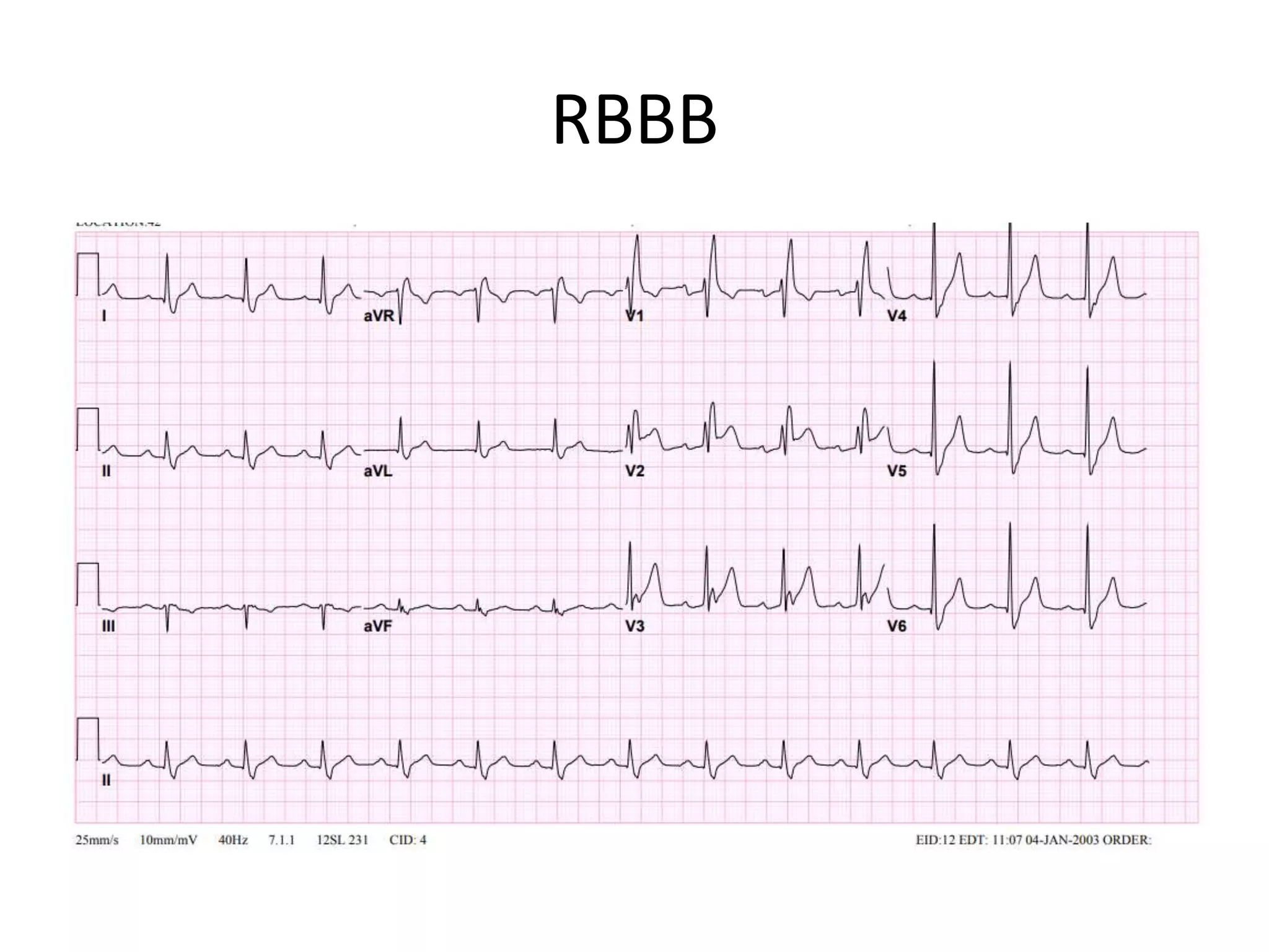 Heart blocks and pacemakers 2019 | PPTX