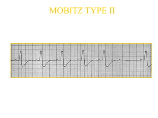Heart blocks and pacemakers 2019 | PPTX