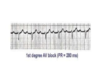 Heart blocks and pacemakers 2019 | PPTX