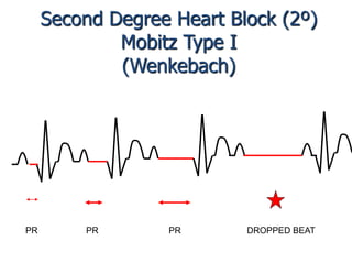 Heart blocks and pacemakers 2019 | PPTX