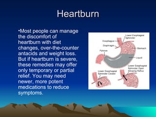 Heartburn | PPT