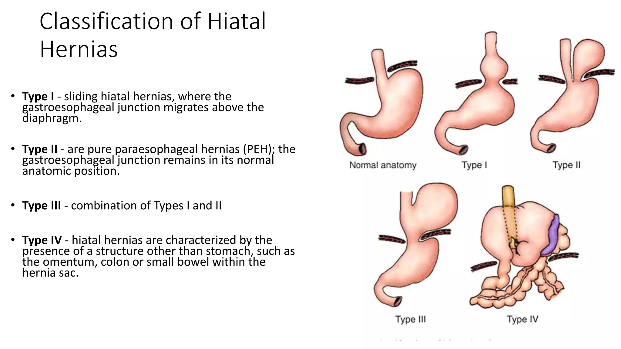 Heartburn and reflux | PPTX | Digestive Disorders | Diseases and Conditions