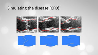 Heart disease and the CFD solution | PPT