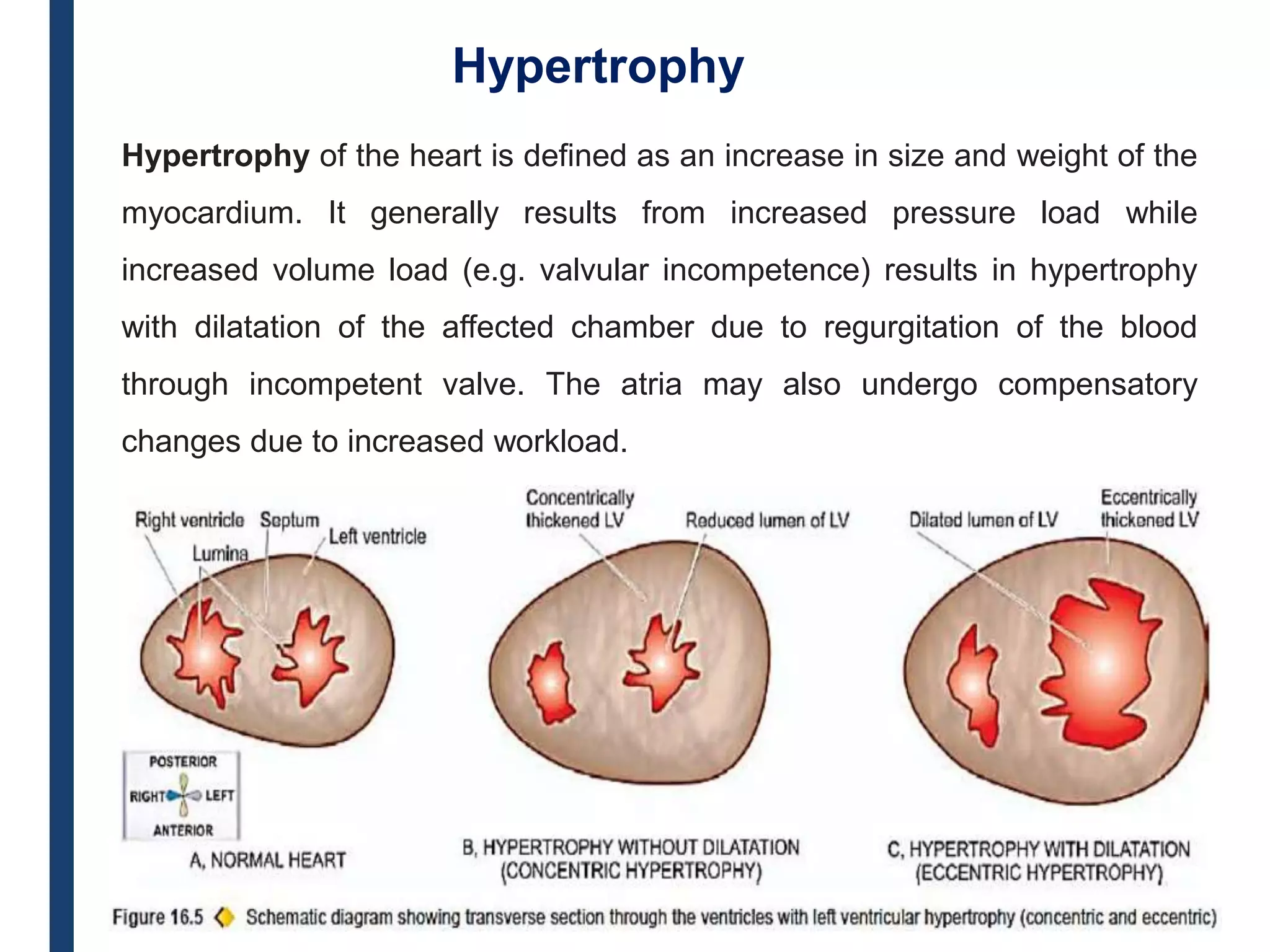 heart disease.pptx