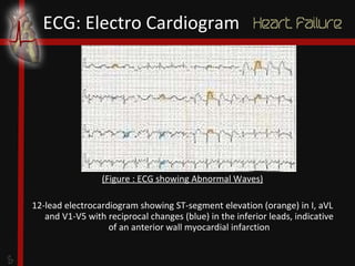 Heart Failure | PPT
