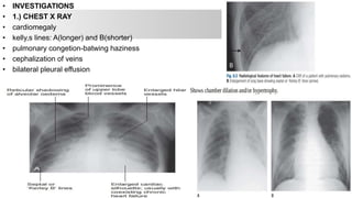 HEART FAILURE.pptx