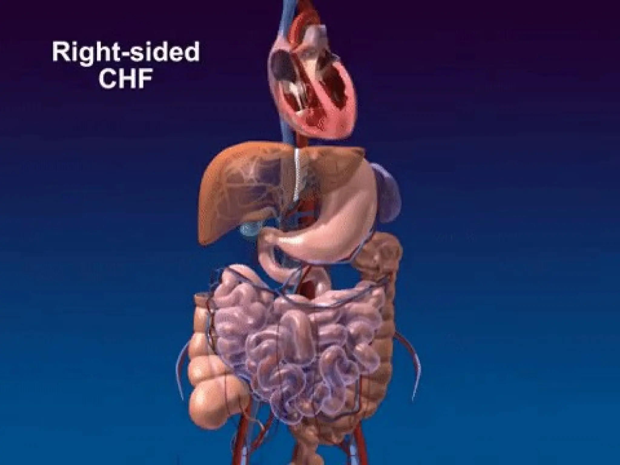 Heart failure.Heart failure, also known as congestive heart failure, is ...