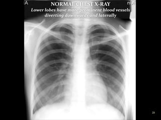 Heart failure radiology group1 year 5 10-11 | PPTX