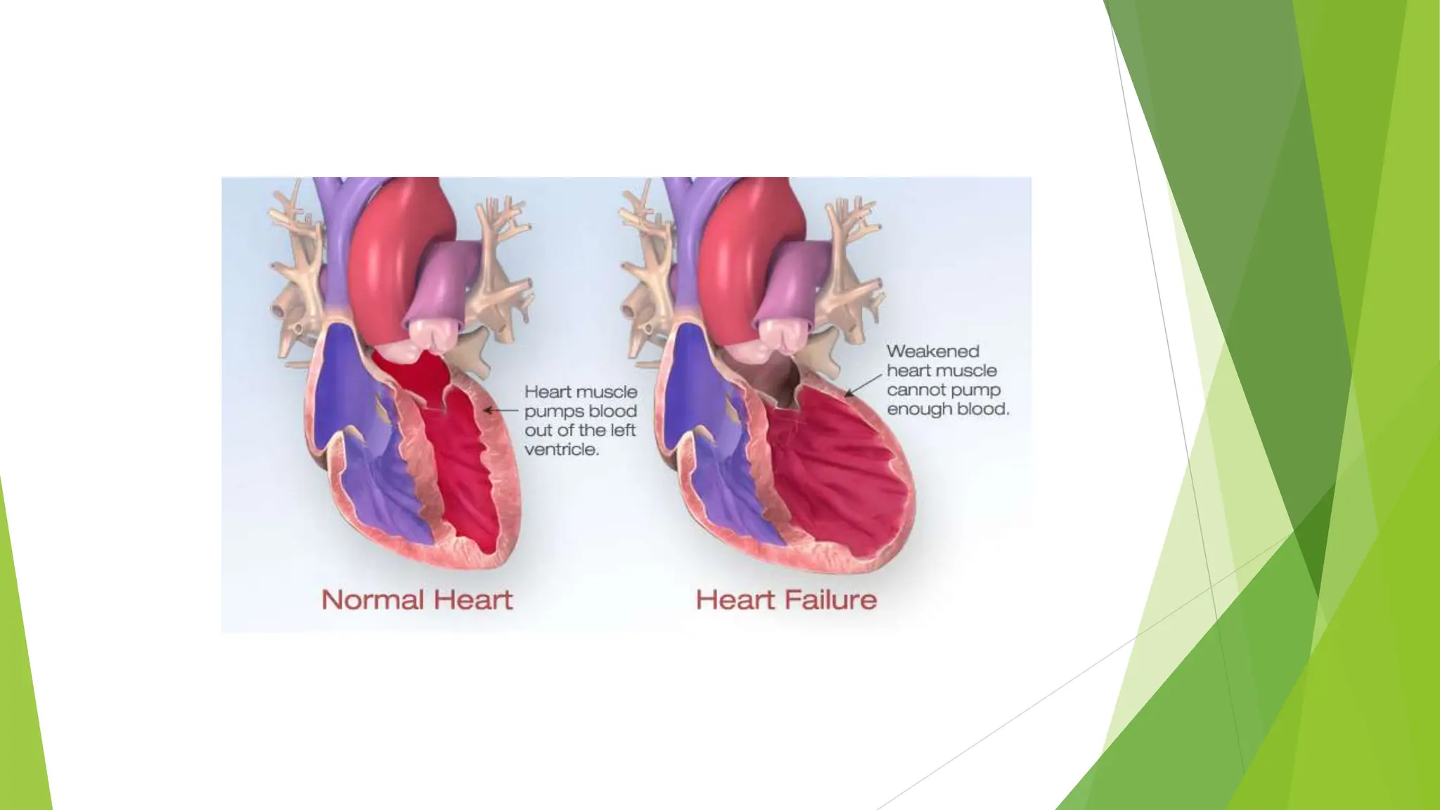 Heart failure , systolic and diastolic dysfunction, management of acute ...