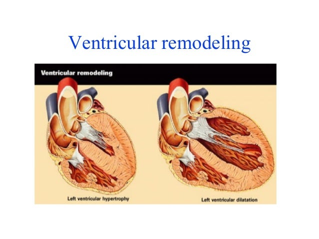 What Is Lv Heart Failure | Paul Smith