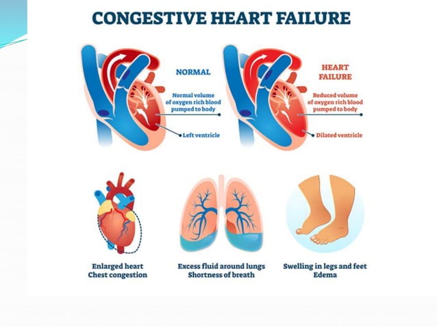 Heart failure in children AND ITS MANAGENMT.pptx