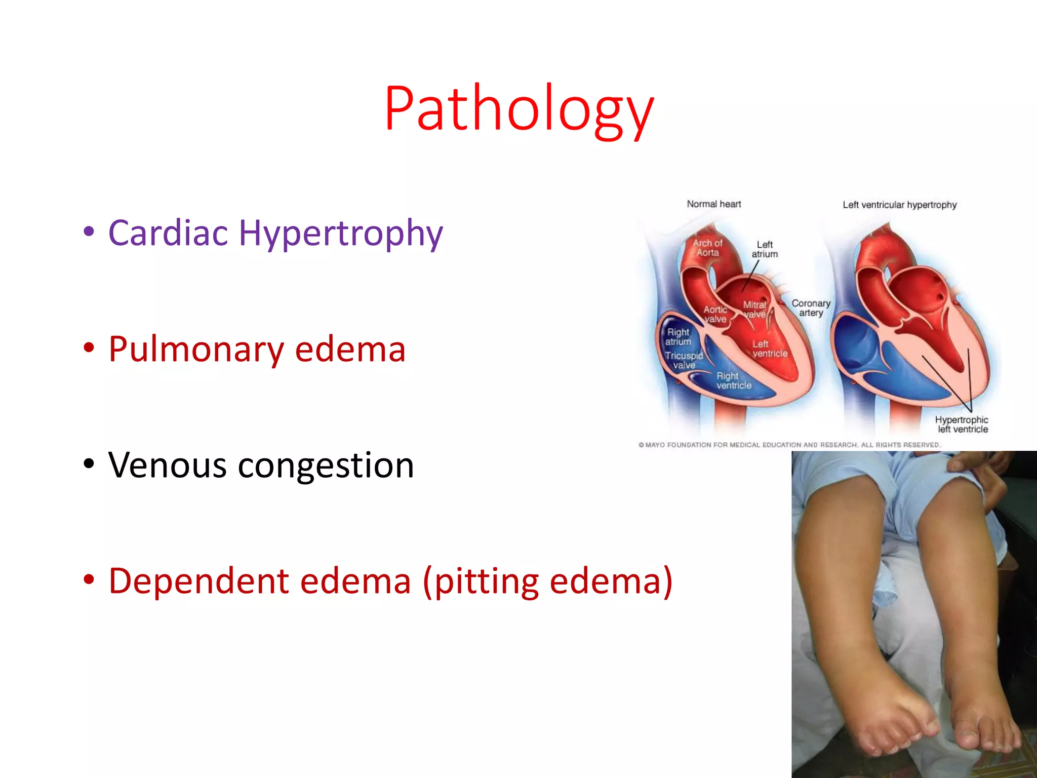 Heart failure in children 2021 | PDF