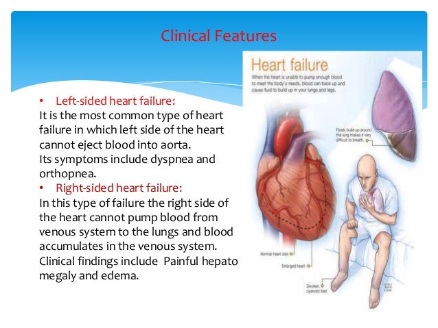 Causes Of Left Sided Heart Failure