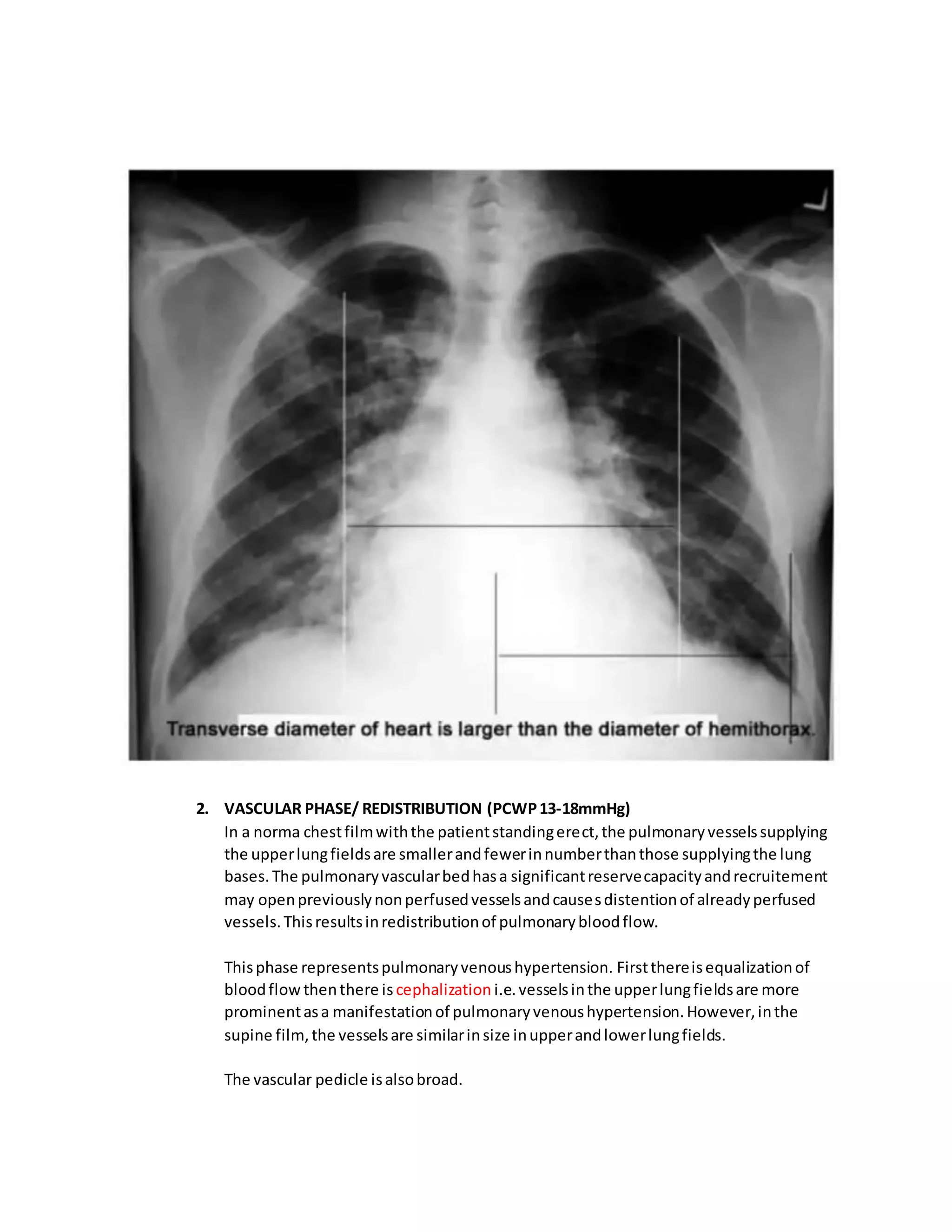 Heart failure radiology | DOCX | Heart and Cardiovascular Diseases ...