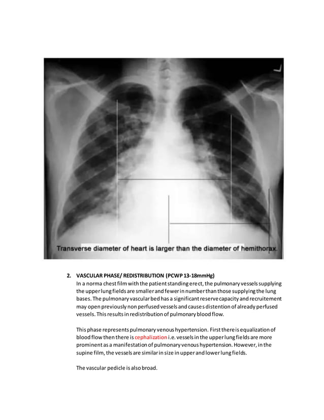 Heart failure radiology | PDF