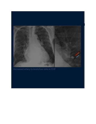 Heart failure radiology | DOCX | Heart and Cardiovascular Diseases ...