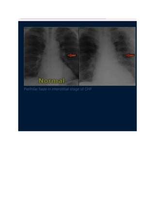 Heart failure radiology | DOCX | Heart and Cardiovascular Diseases ...