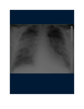 Heart failure radiology | DOCX | Heart and Cardiovascular Diseases ...