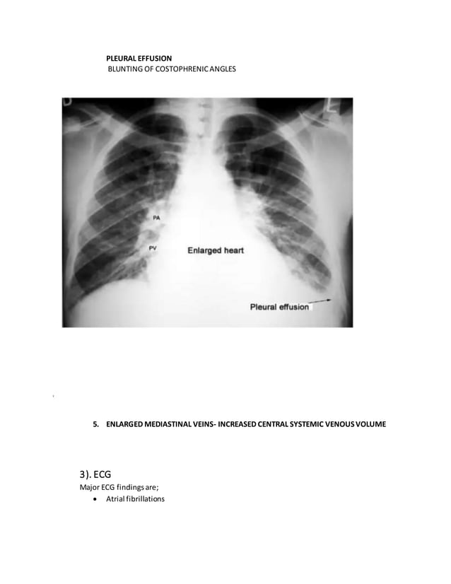 Heart failure radiology | PDF