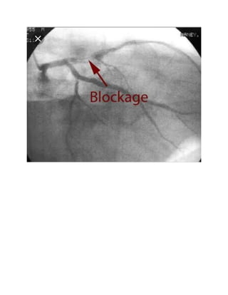 Heart failure radiology | DOCX | Heart and Cardiovascular Diseases ...