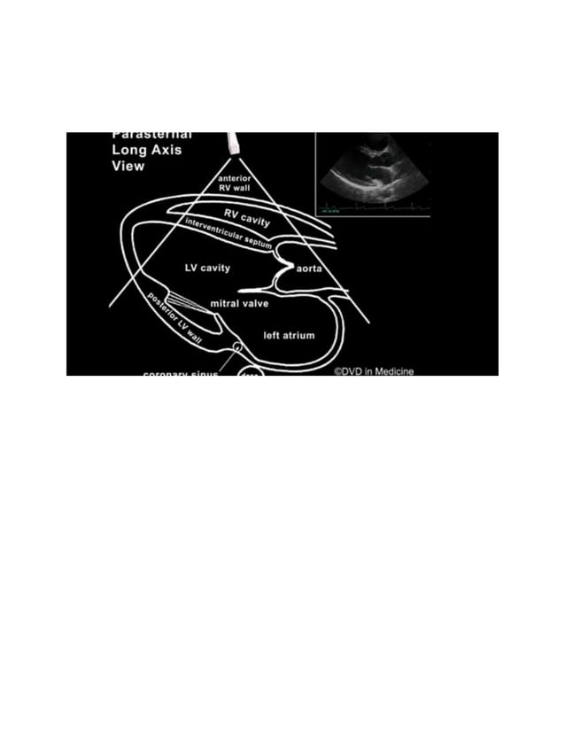 Heart failure radiology | PDF
