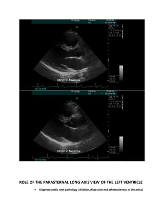 Heart failure radiology | DOCX | Heart and Cardiovascular Diseases ...
